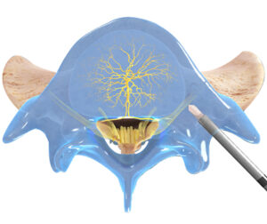 Intracept | Pacific Sports & Spine