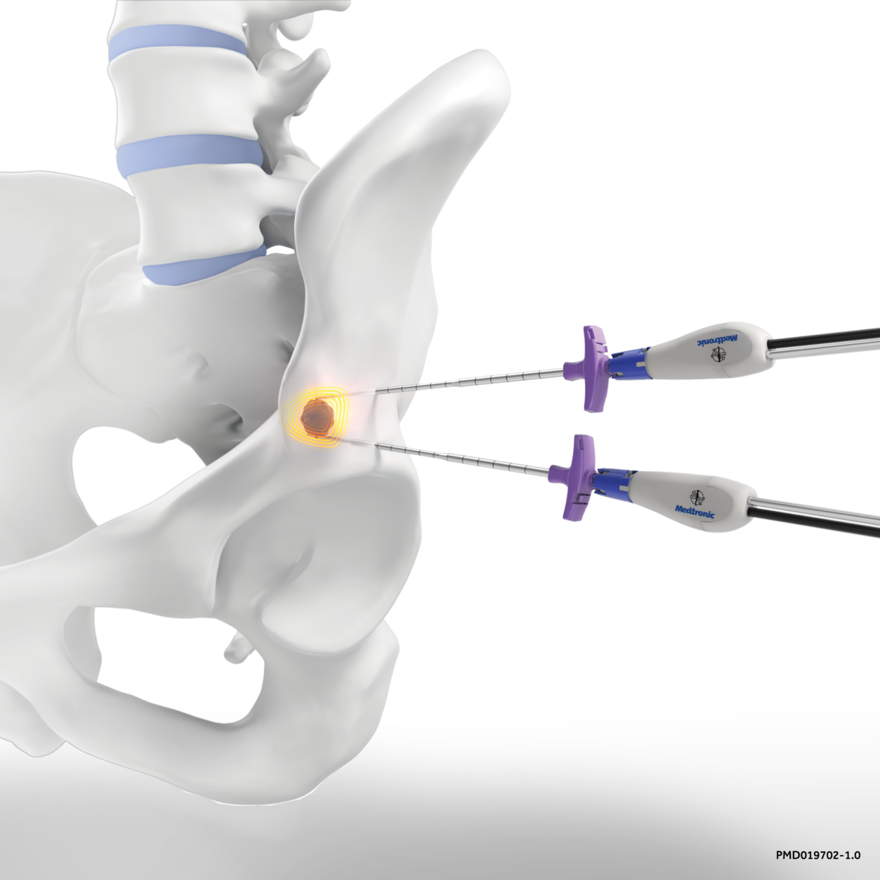 Radiofrequency Ablation | Pacific Sports & Spine