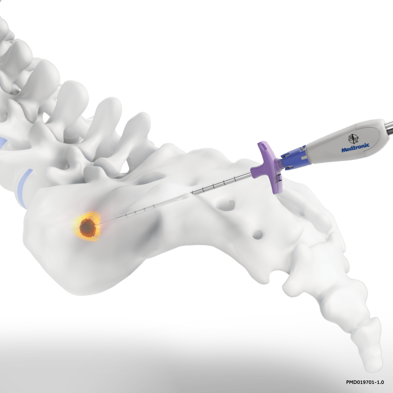 Osteocool | Pacific Sports & Spine