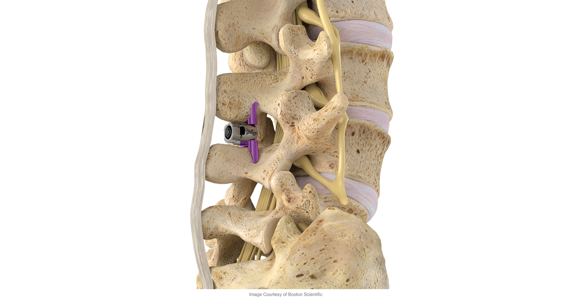 Vertiflex | Pacific Sports & Spine