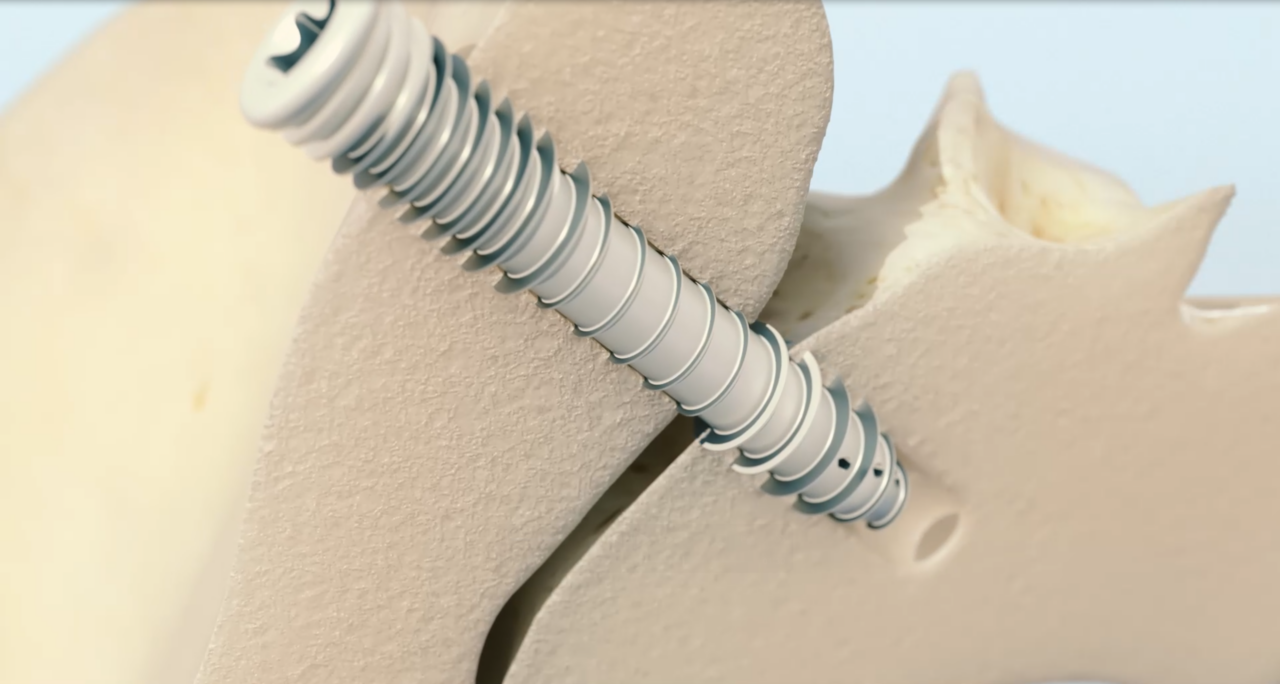 CornerLoc & TransLoc for SI Joint Dysfunction | Pacific Sports & Spine